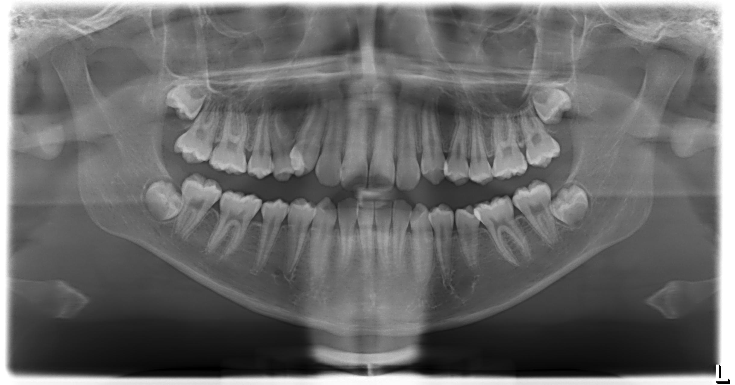Class impacted-tooth Object Detection Dataset by project-sa6by