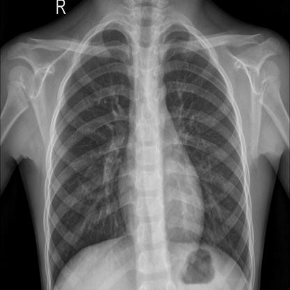 Pneumonia detection Model Object Detection Dataset by SEAGRASS PROJECT