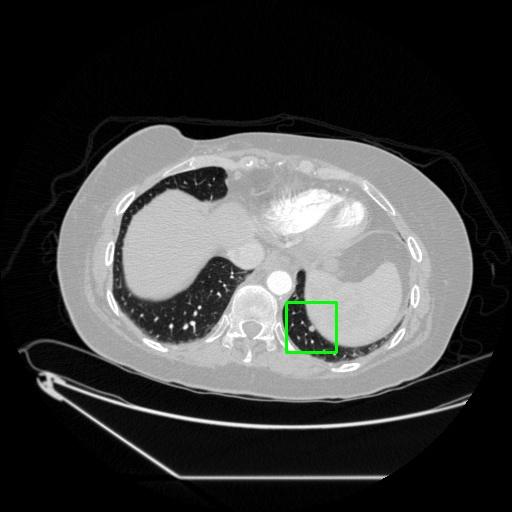 Lung Nodule Classification Classification Dataset And Pre Trained Model