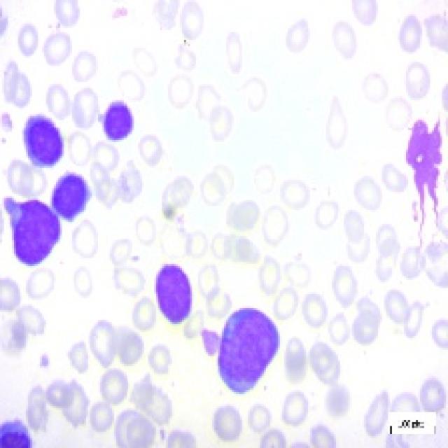 leukemia Object Detection Model by Tawfiq Islam
