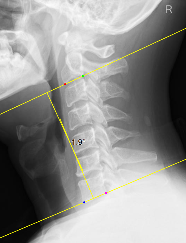 radiografias cervical Classification Dataset by Irai cardenas