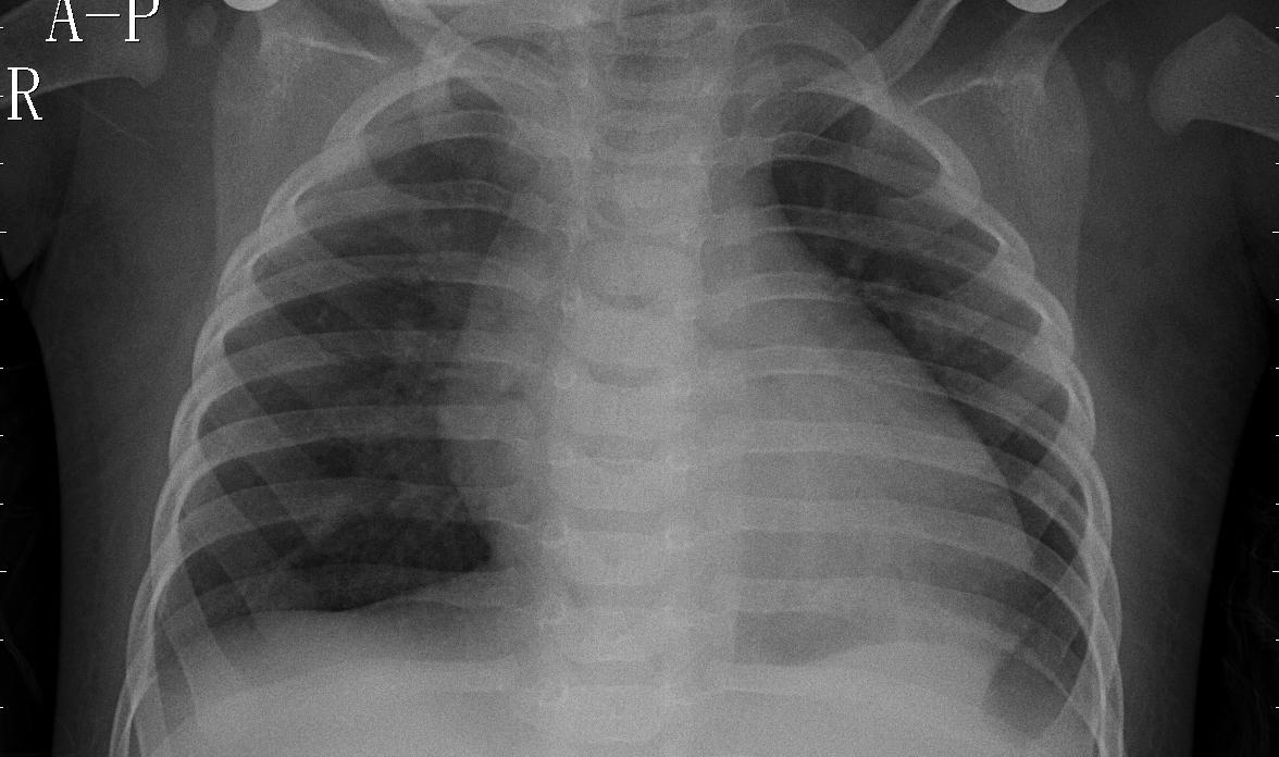 Pneumonia Classification Dataset By Binaryclassification