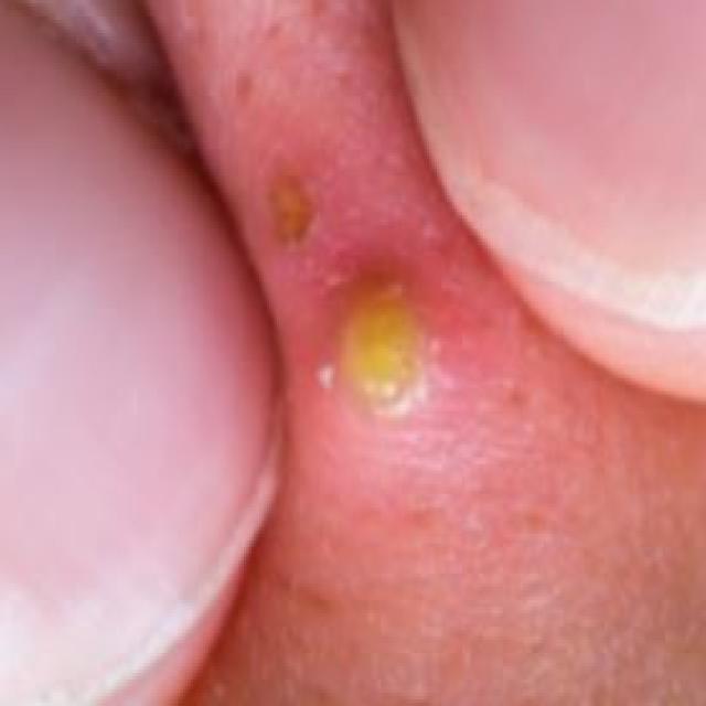 Dataset Jerawat Fix Object Detection Dataset And Pre Trained Model By Skripsi Bismillah