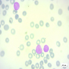blood cancer Classification Model by dataset