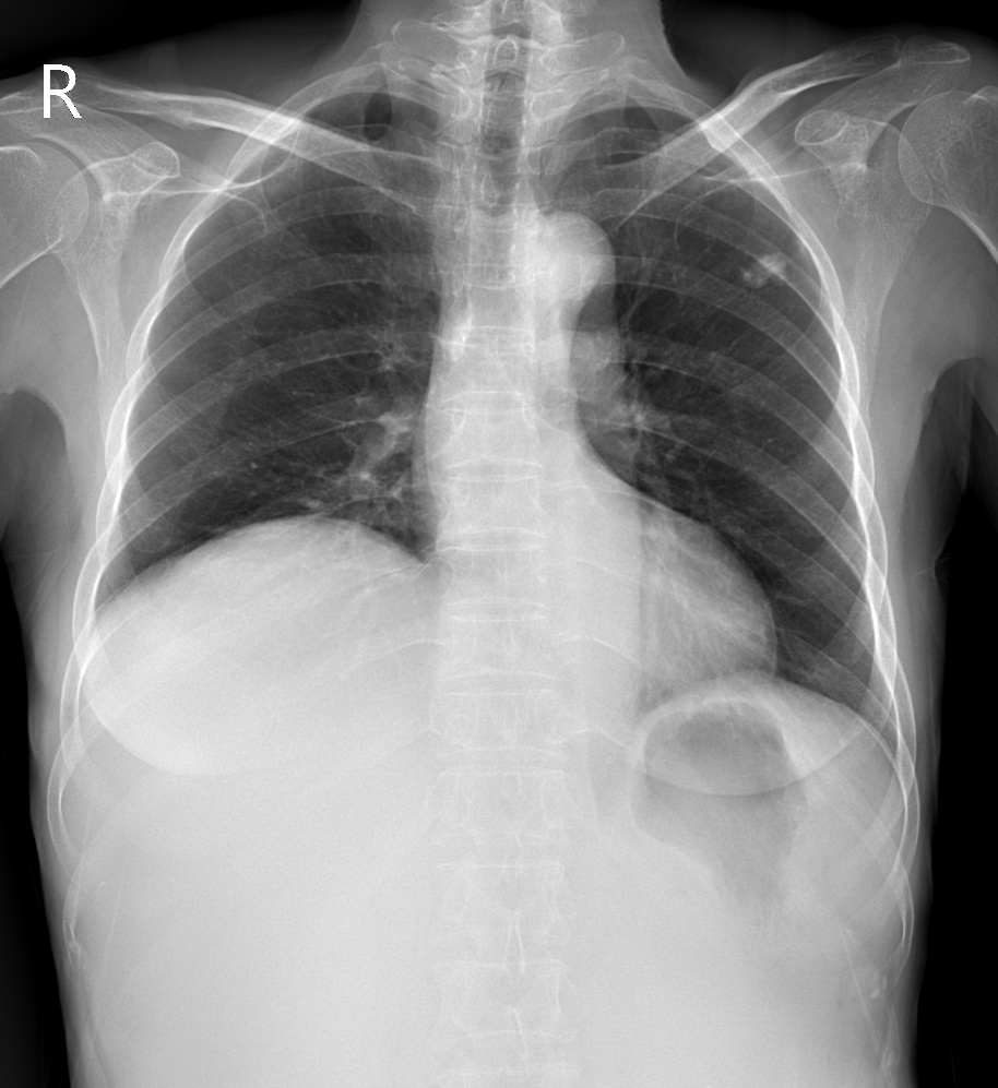 Cxr Lesion Detection Test Object Detection Dataset By Krid Sumangsri