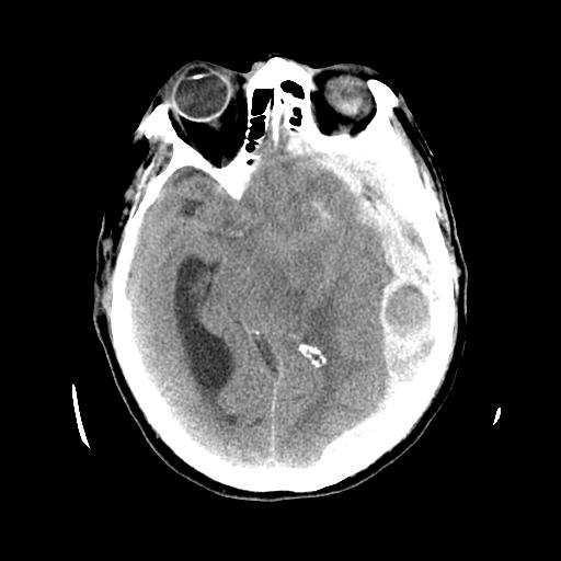 Ct brain hemorrhage Object Detection Dataset by Krid Sumangsri