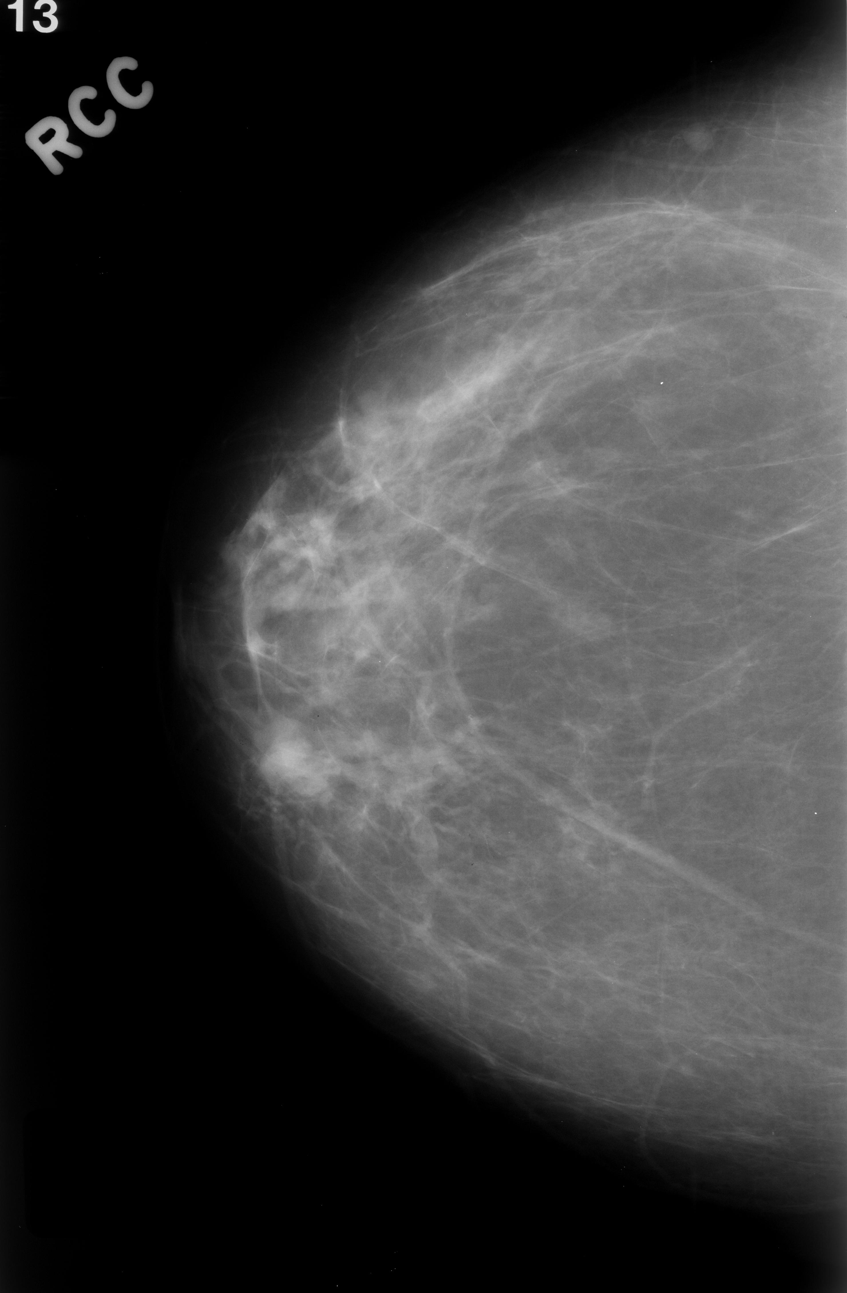 Breast_Cancer_Classification Object Detection Dataset by Milad Aghalari