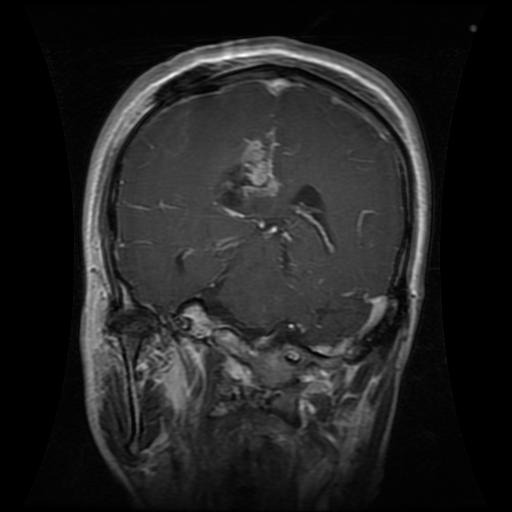 Tumor Classification And Localization Object Detection Dataset And Pre Trained Model By Ali Rehman