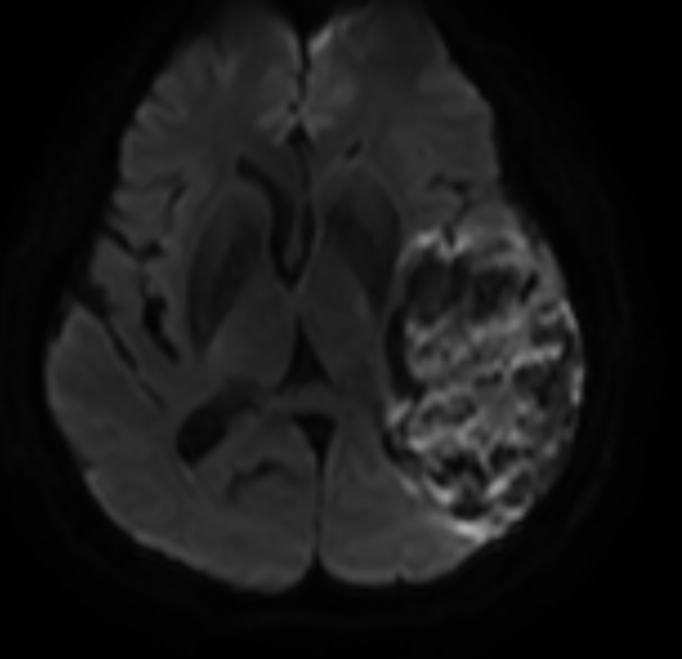 DWI BLEED DETECTION - Roboflow Universe