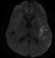 DWI BLEED DETECTION - Roboflow Universe