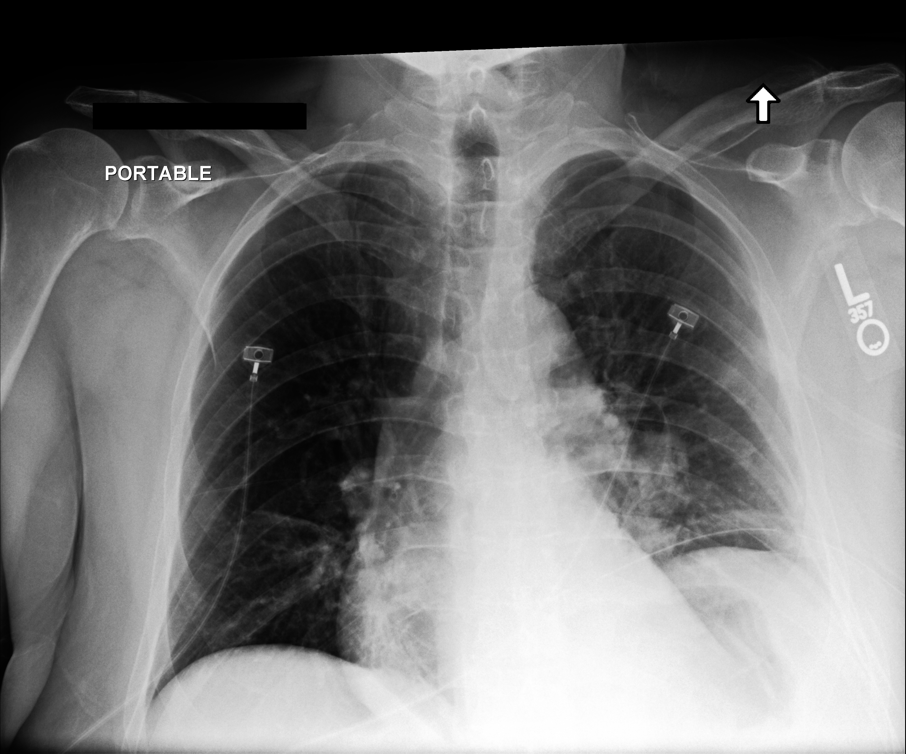Cxr Anatomy Instance Segmentation Dataset By Medical Aiml