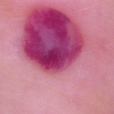 skin_lesion_classification Classification Dataset by Major Project