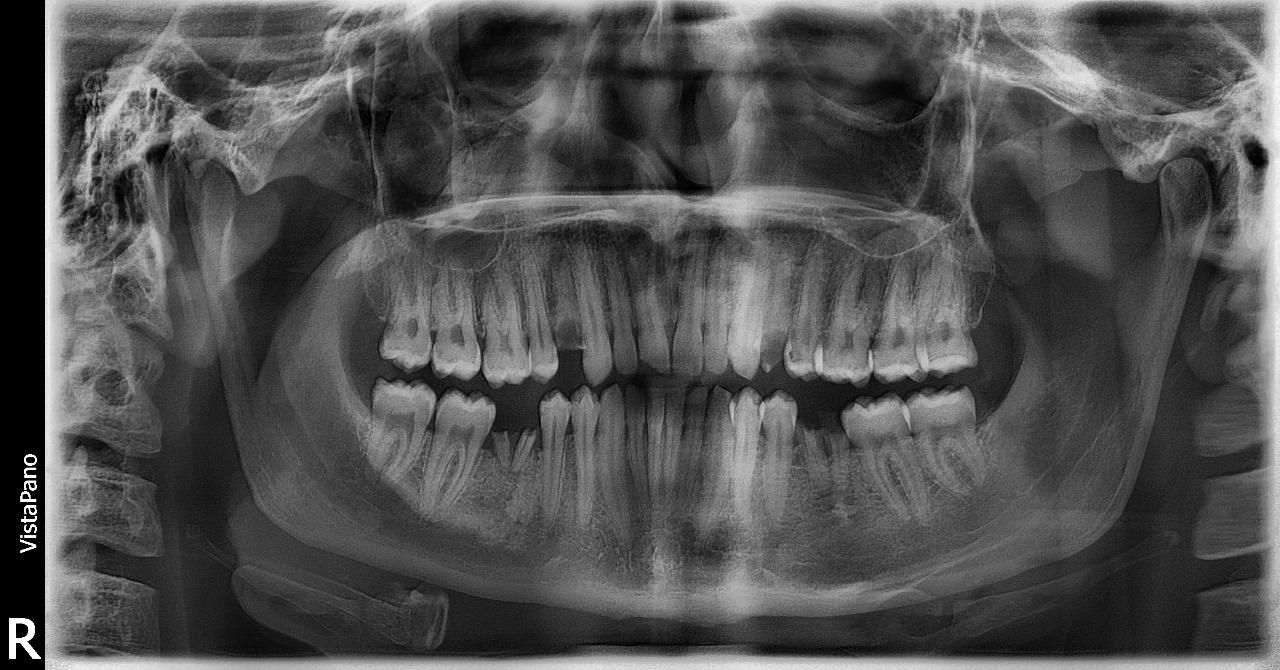 Teeth 3 Instance Segmentation Dataset and Pre-Trained Model by demo