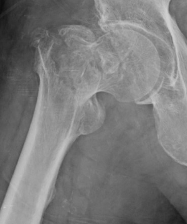 hip frature object detection Object Detection Dataset by Huong