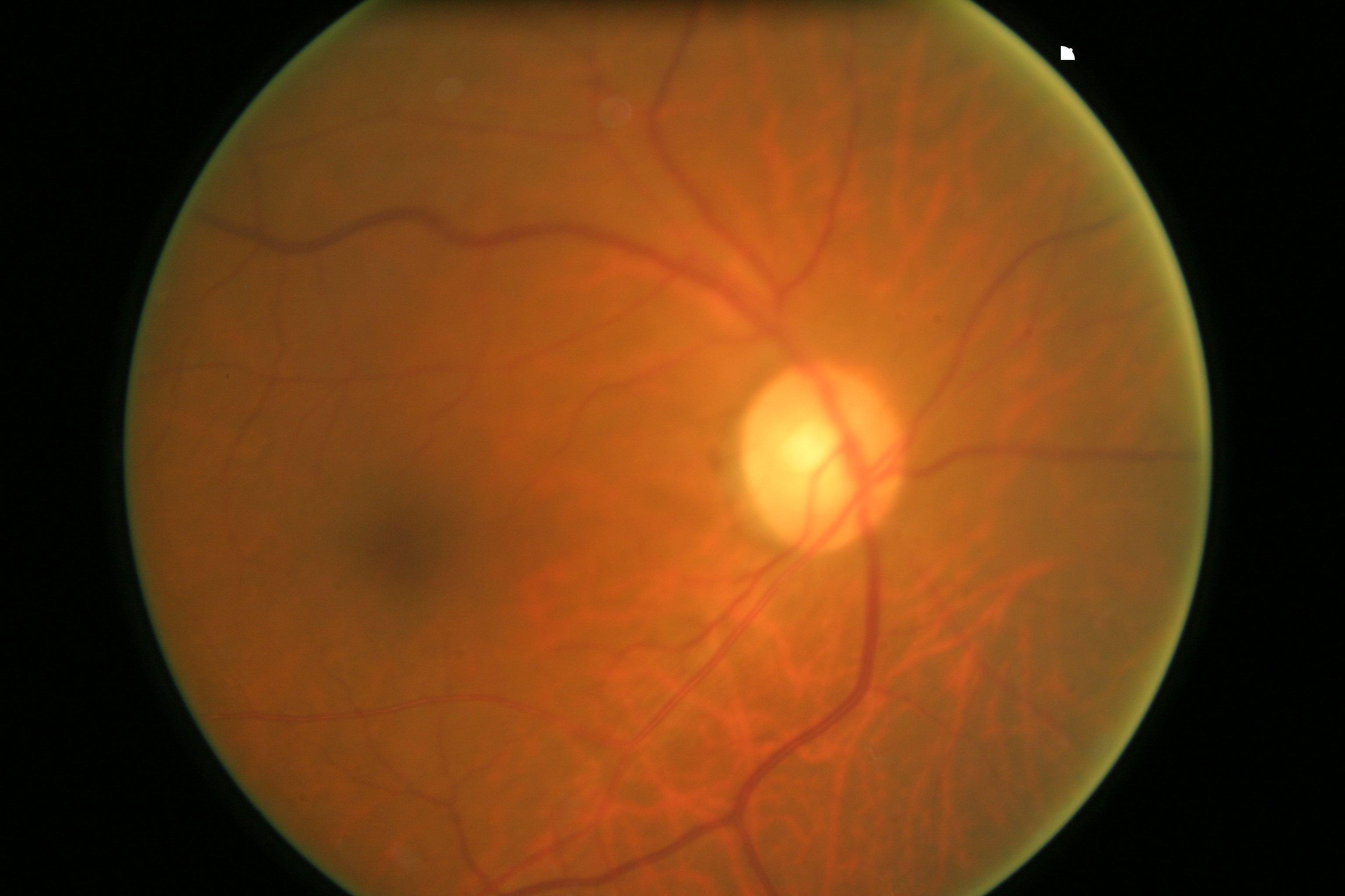 Eye Classification Dataset And Pre Trained Model By Fyp