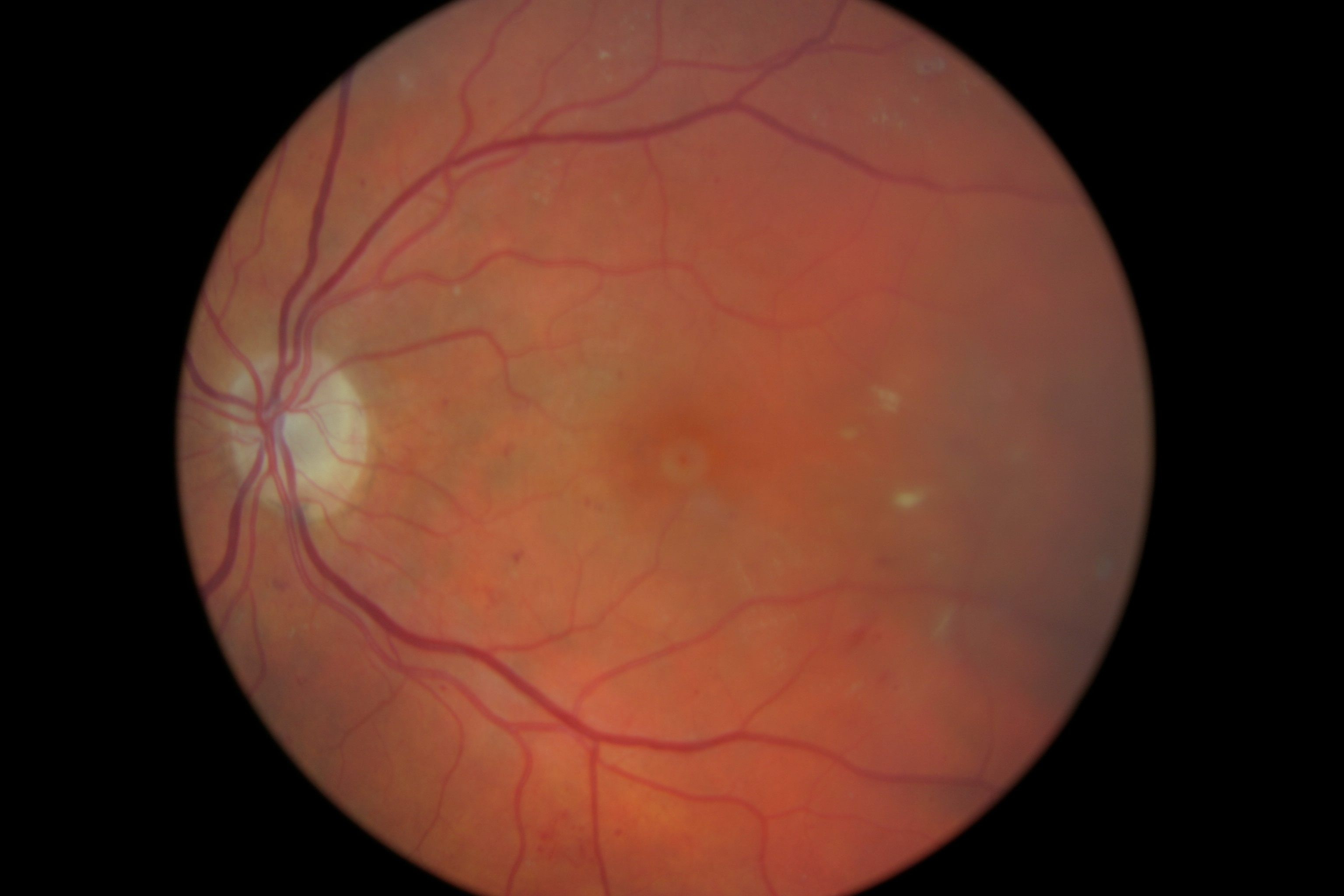 Glaucoma Object Detection Dataset And Pre Trained Model By Glaucoma