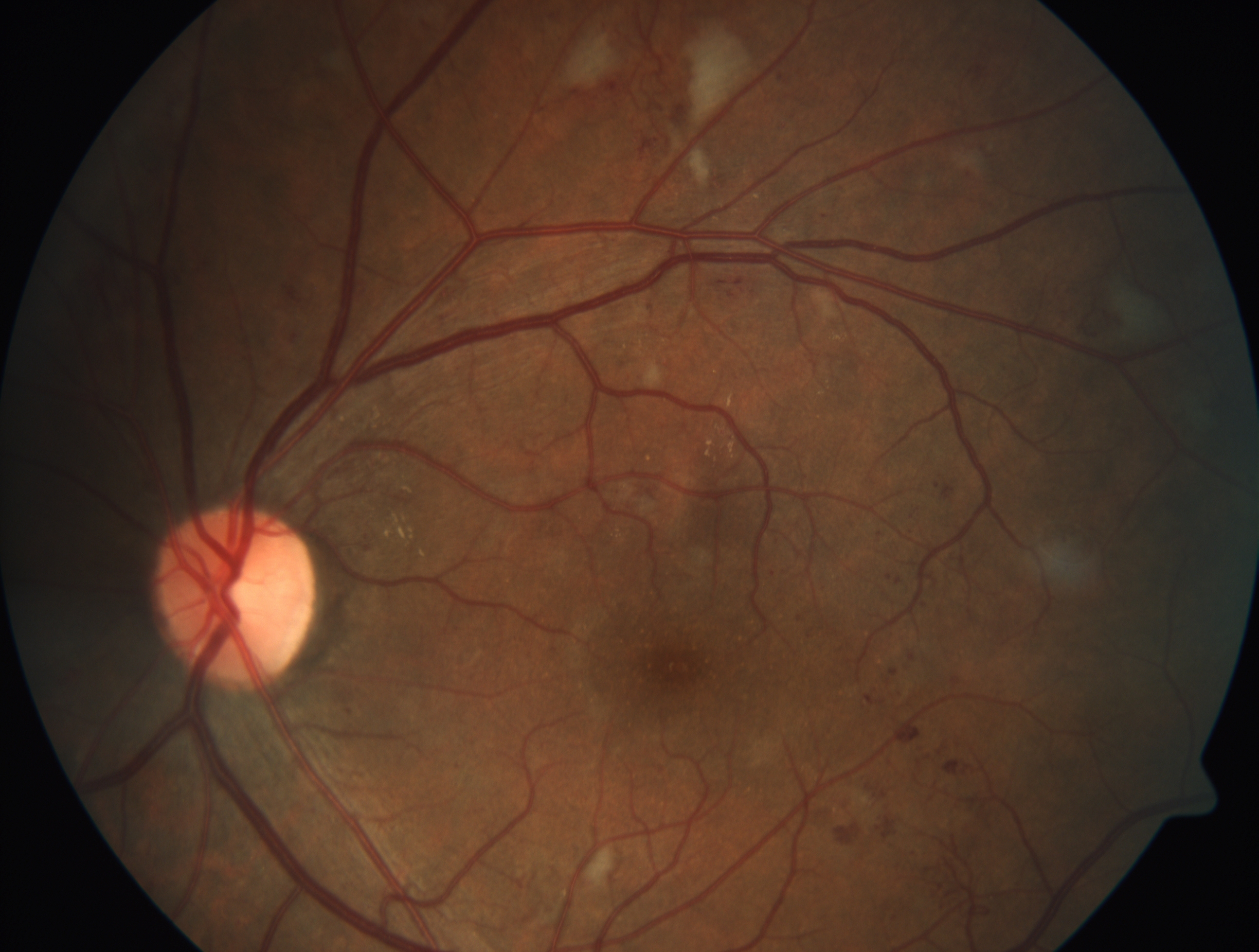 final year project-blindness detection Object Detection Dataset by nishok
