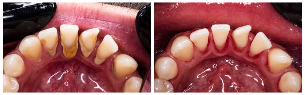 Gingivitis Object Detection Model by Digital Health BG