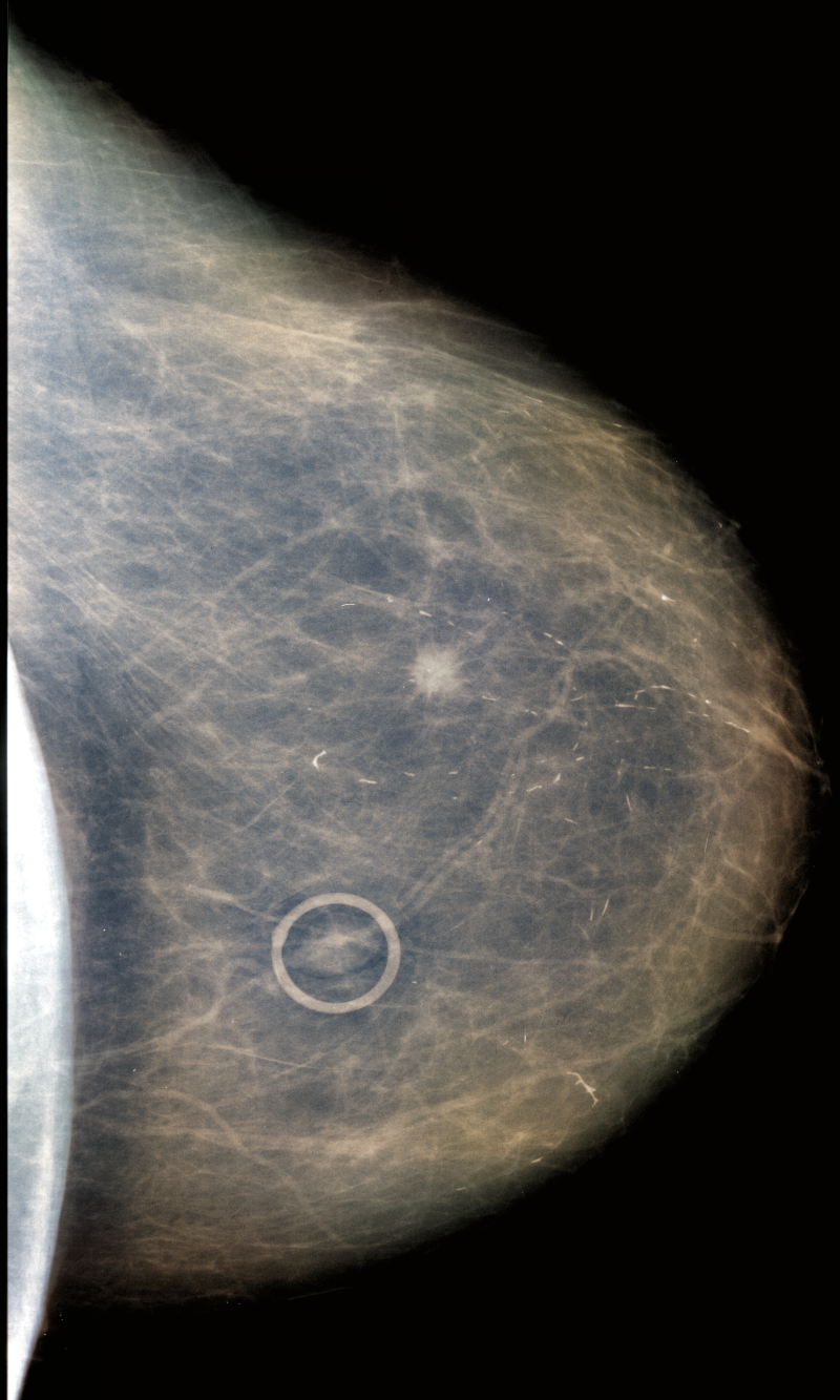 CBIS-DDSM Object Detection Dataset and Pre-Trained Model by wound