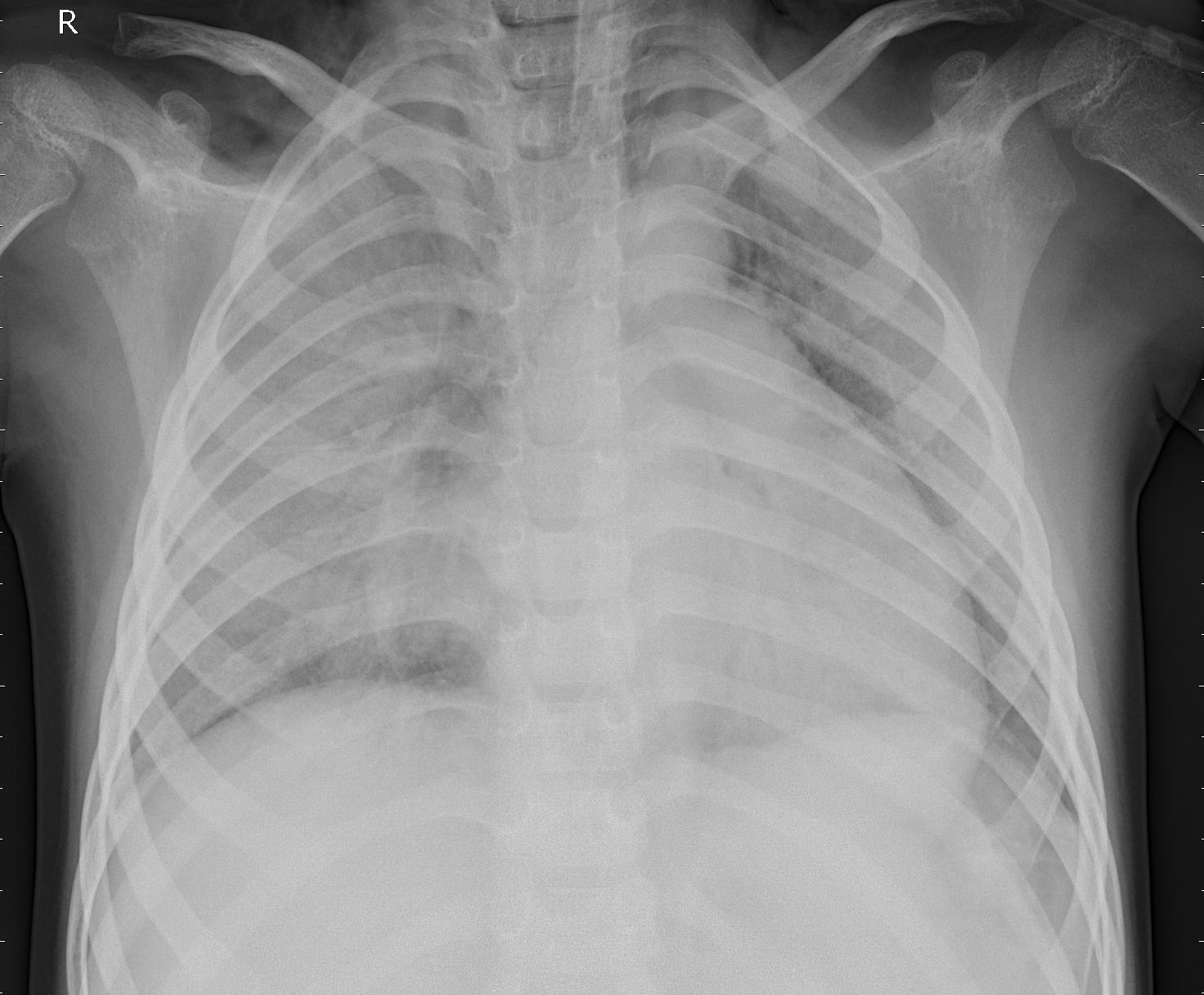 Pneumonia Detection Classification Dataset And Pre Trained Model By