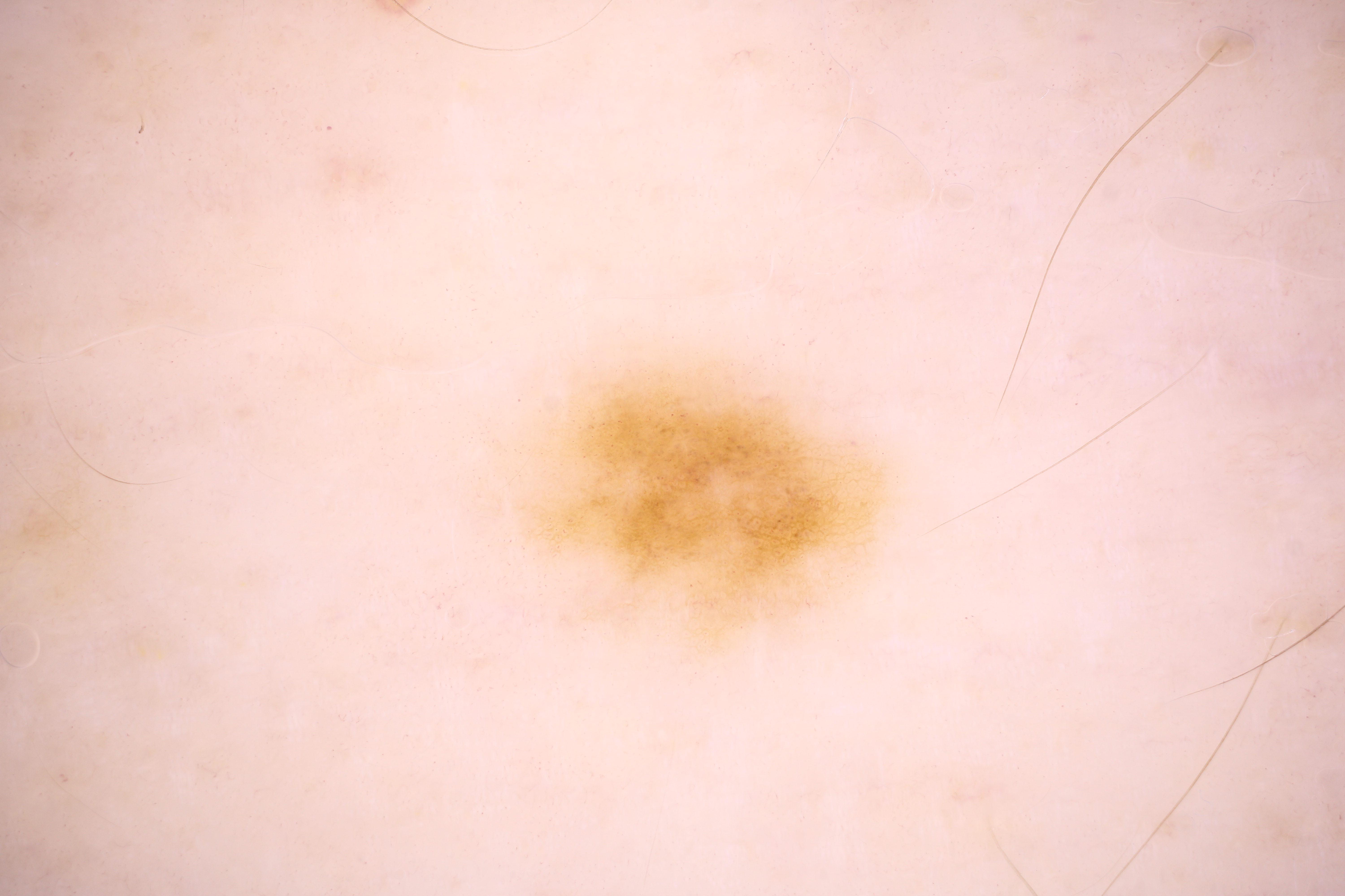 Skin Cancer Detection Object Detection Dataset by Striver