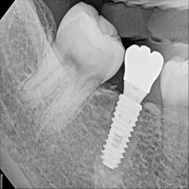 Implant Tooth Segmentation Instance Segmentation Dataset By