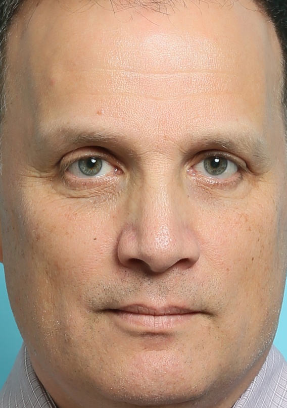 Forehead Object Detection Model by HaNoi University of Science and Technology