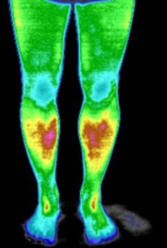 Thermal medical detection Instance Segmentation Model by MyORG