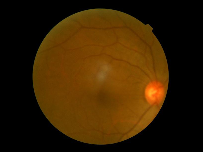 Aptos Final Object Detection Dataset by Aptos and DDR Final