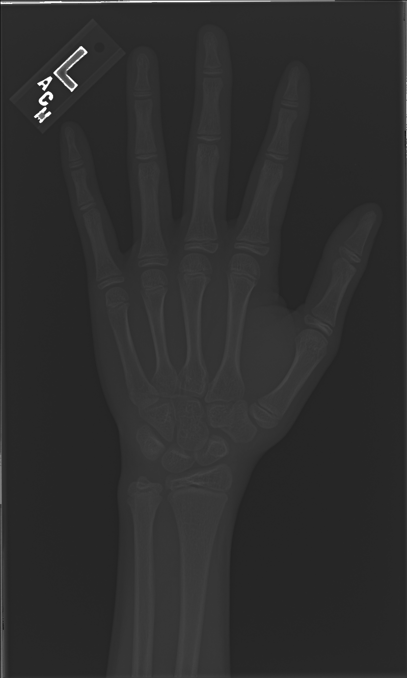 Joints 1 Object Detection Dataset By Boneage