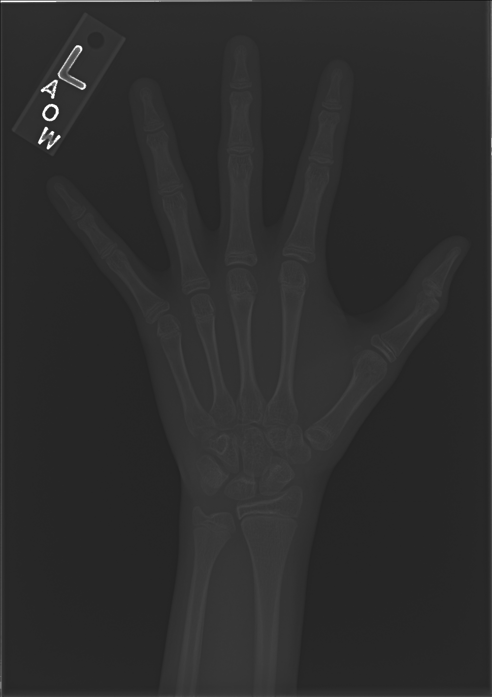 Hand-bones Instance Segmentation Dataset by boneage