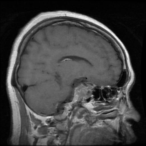 MRI Classification Dataset by Tugas Akhir