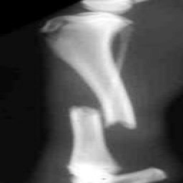 bone fracture Classification Model by Helwan university