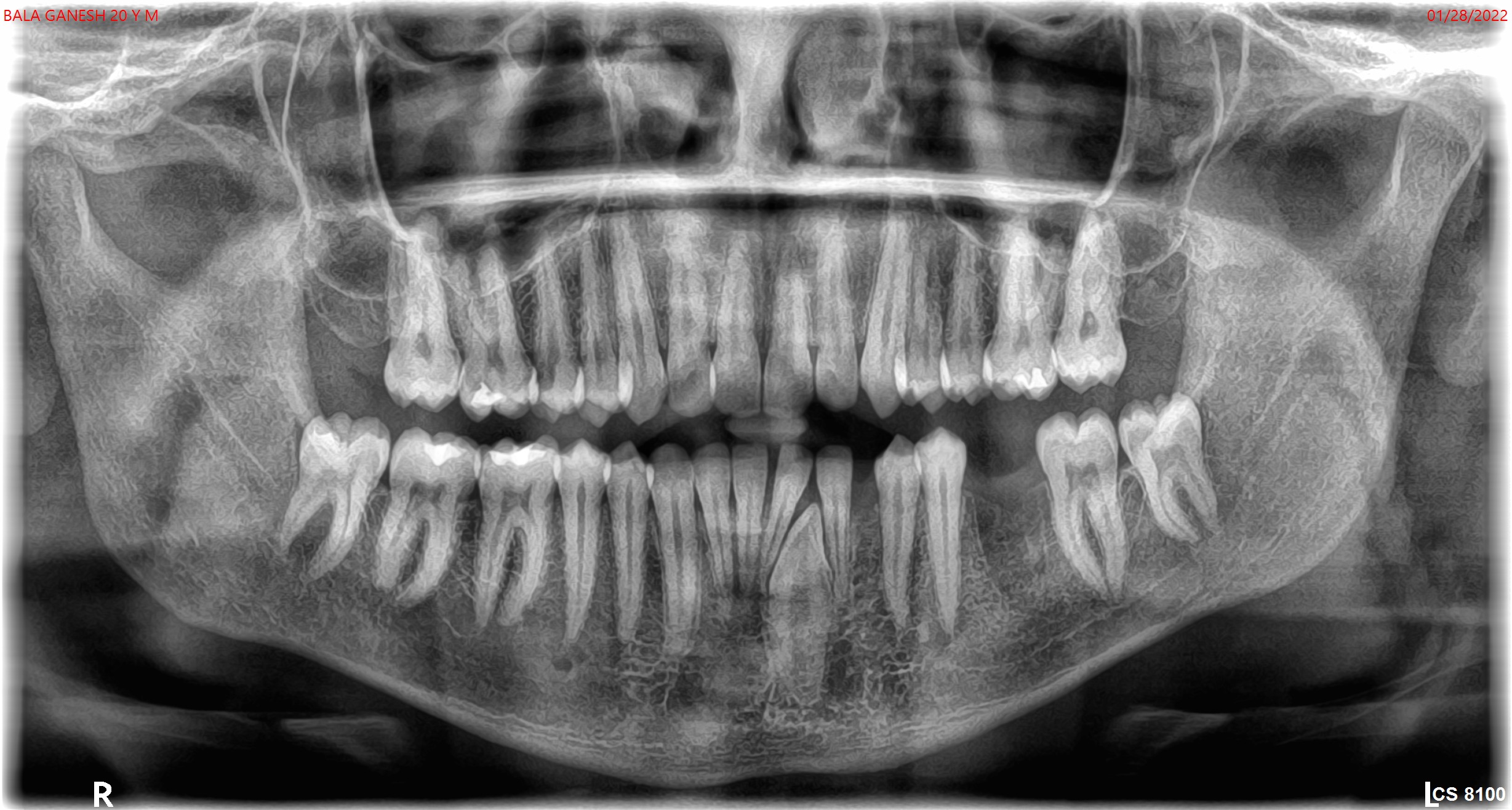 TMJ EVALUATION 2 Object Detection Dataset and Pre-Trained Model by ROCKY