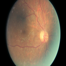 Cataract-Fundus Classification Dataset by Thanhdehunter