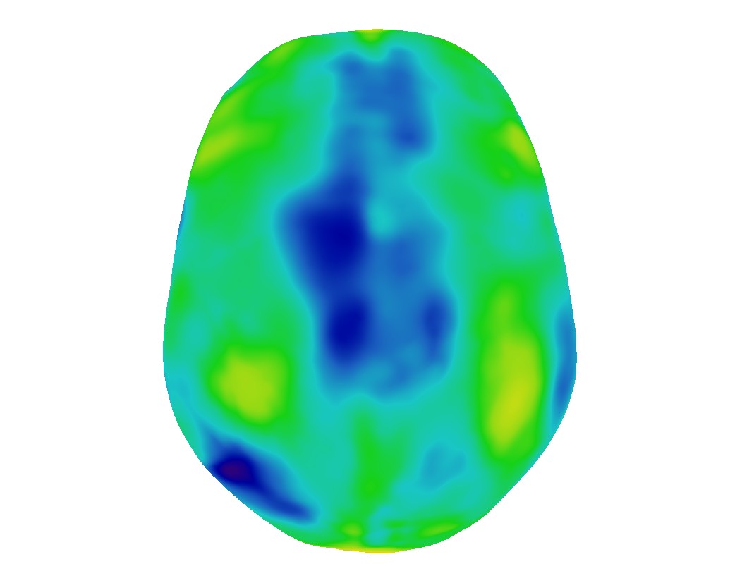 Parietal-region Classification Model by LLL