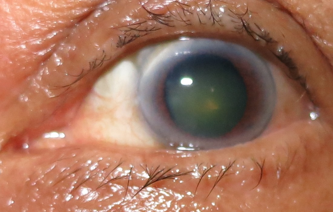 Cataract (Normal) Classification Dataset by Akmal Rusdy