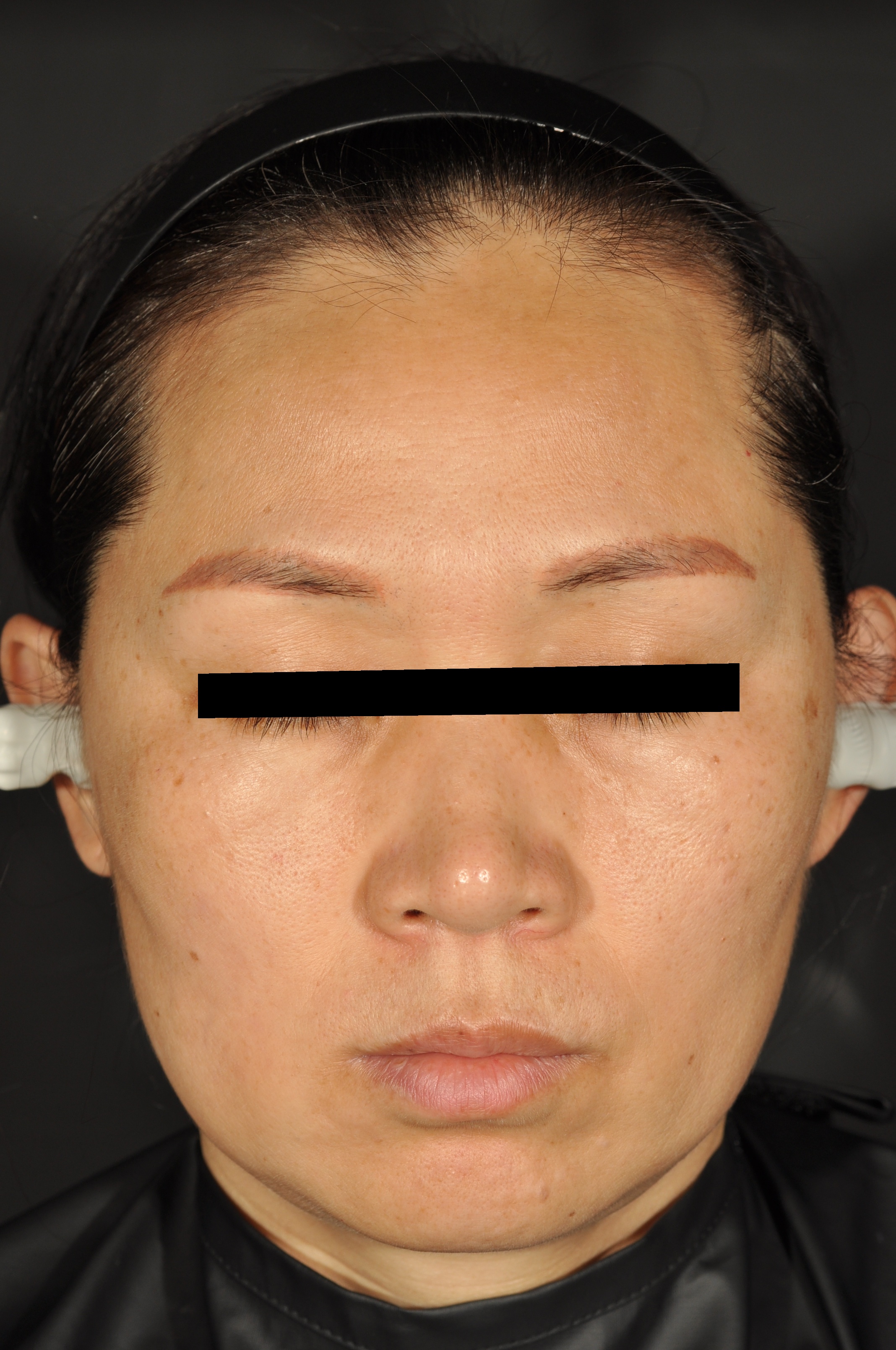 Acne Classification Model by project-essx1