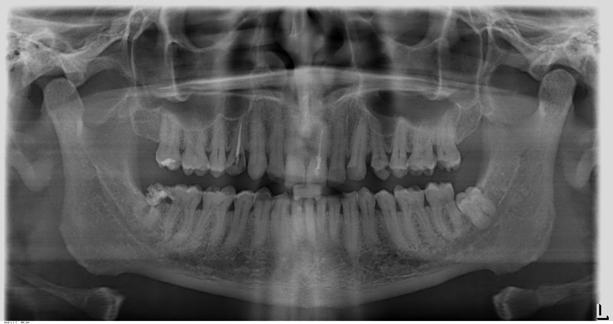 Perio OPG Annotation Instance Segmentation Dataset and Pre-Trained ...