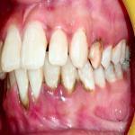 New Gingivitis classification 2 Classification Model by BETiC Project