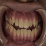 Gingivitis Classification Classification Dataset and Pre-Trained Model ...