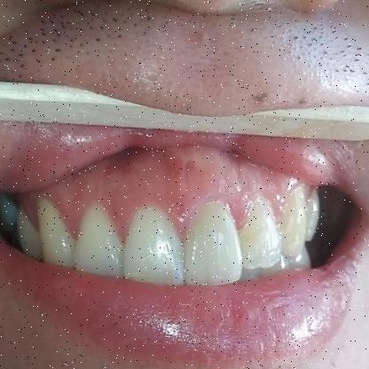 teeth-instance-seg Instance Segmentation Dataset and Pre-Trained Model by university