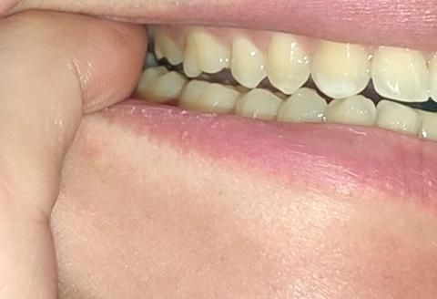 teeth-shade-test Object Detection Model by university