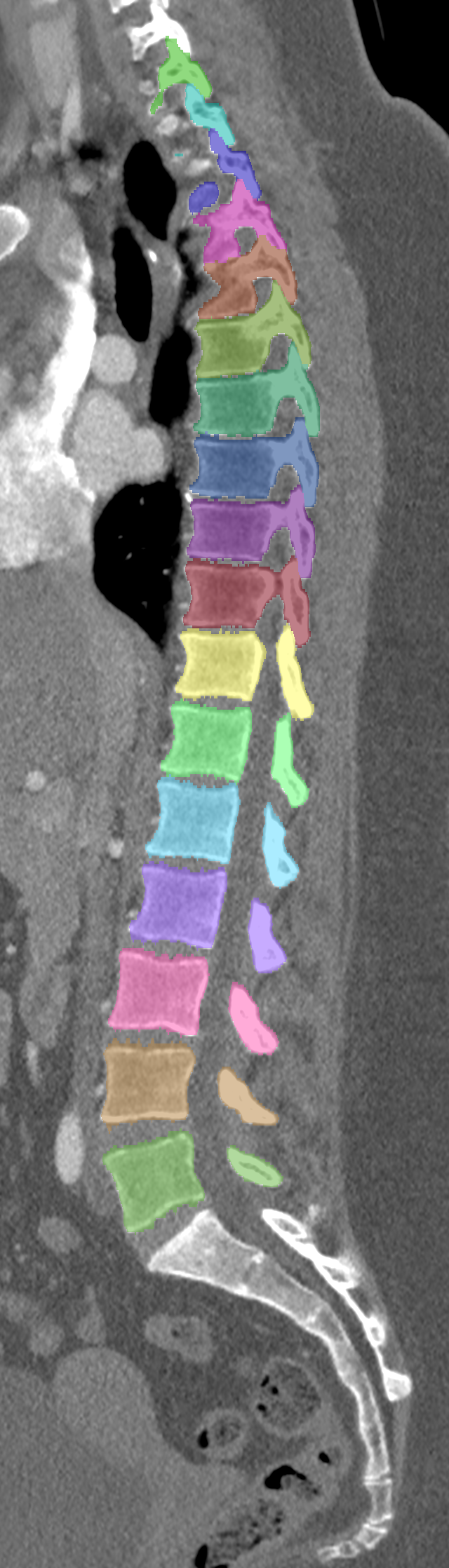 Spine-and-Vertebrae-Segmentation |CSI 2014 Workshop |Challenge 1 Instance Segmentation Model (v1 ...