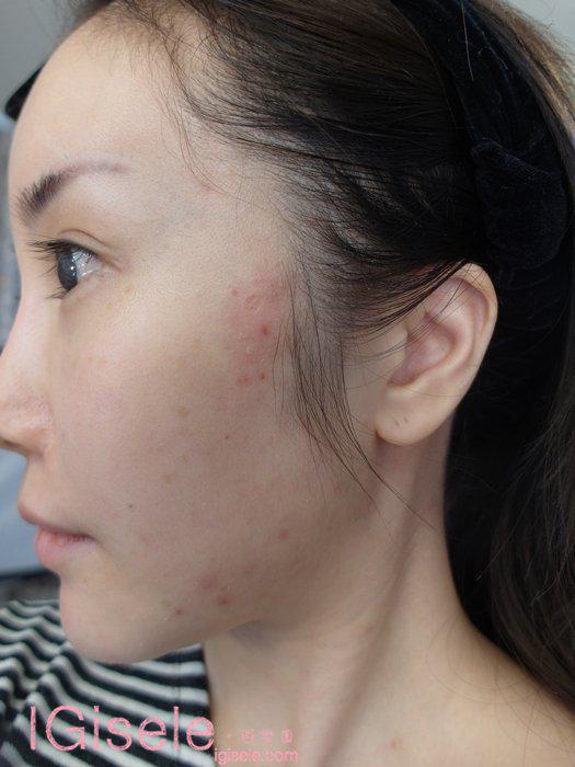 Acne Det ACNE04 exploration Object Detection Dataset by faceinc