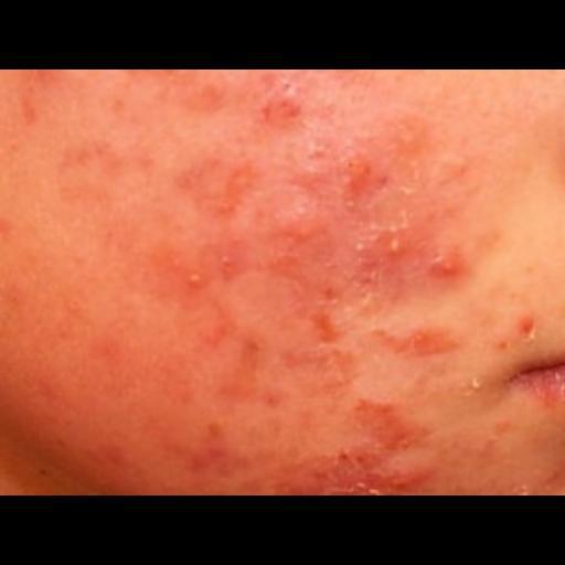 Tugas Object Detection Dataset and Pre-Trained Model by Acne