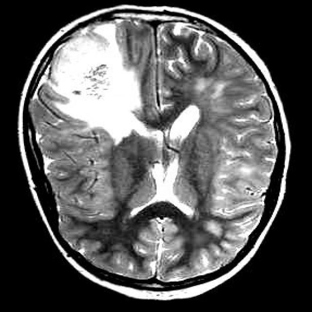 Brain tumor detection Object Detection Dataset and Pre-Trained Model by ...