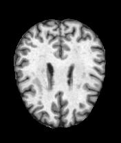 Alzheimer’s Disease Detection Object Detection Model (v1, 2023-07-24 12 ...
