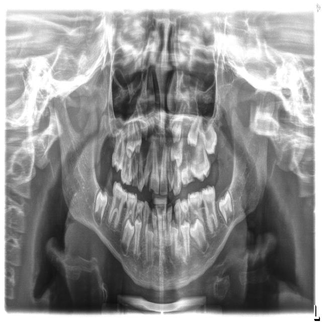 Tooth detection Object Detection Dataset and Pre-Trained Model by Unbosque