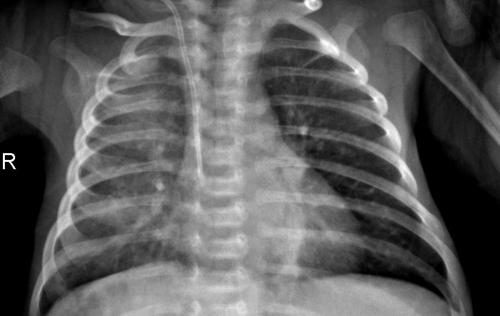 chest Object Detection Dataset by chest